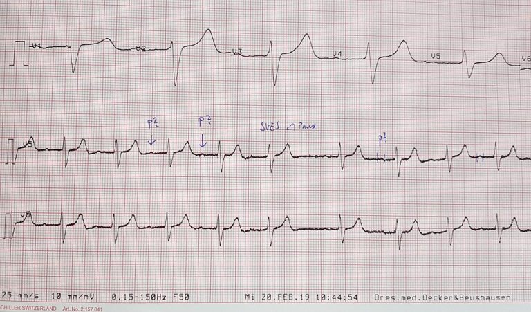 What You Need To Know About PJC ECG: A Guide For Clinicians – Figure 8
